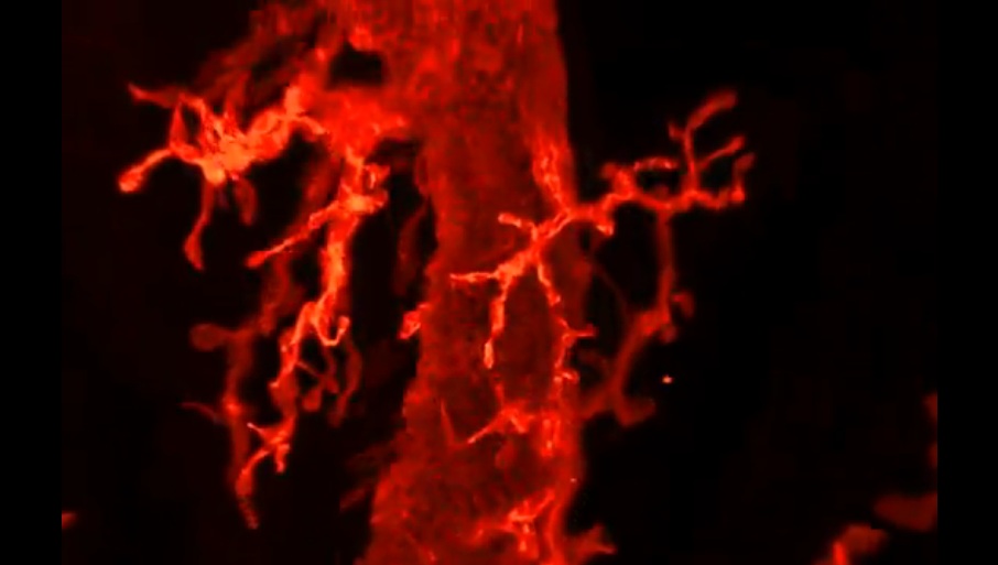 新3D成像：胰腺癌是如何开始的 - 生物通